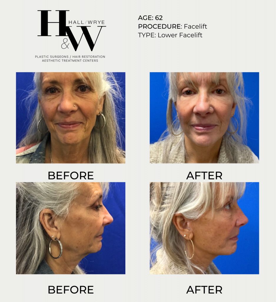 Facelift - Hall & Wrye Plastic Surgeons, Hair Restoration, Medical Spa ...