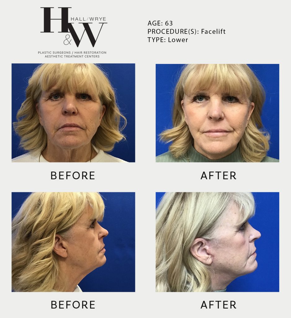 Facelift - Hall & Wrye Plastic Surgeons, Hair Restoration, Medical Spa ...