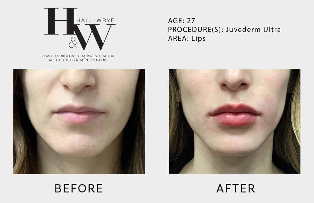 Lip Filler Gallery - Hall & Wrye Plastic Surgeons, Hair Restoration ...