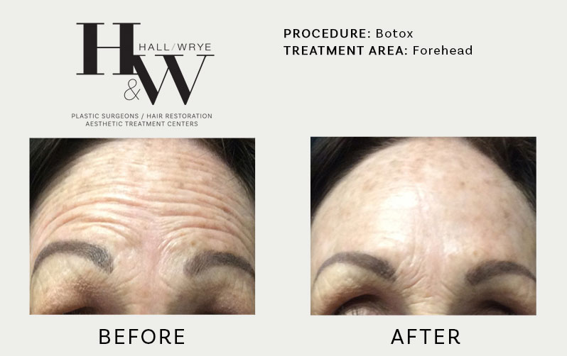 Botox and Dysport - Hall & Wrye – Plastic Surgery and Medical Spa in ...