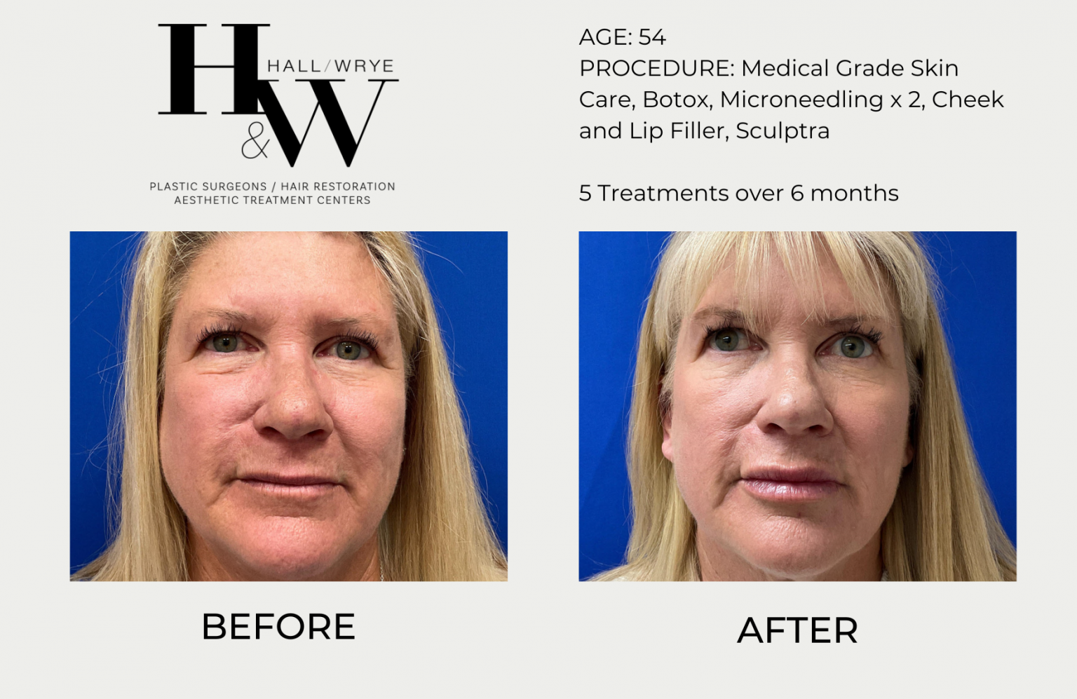 Sculptra - Hall & Wrye – Plastic Surgery and Medical Spa in Reno NV ...