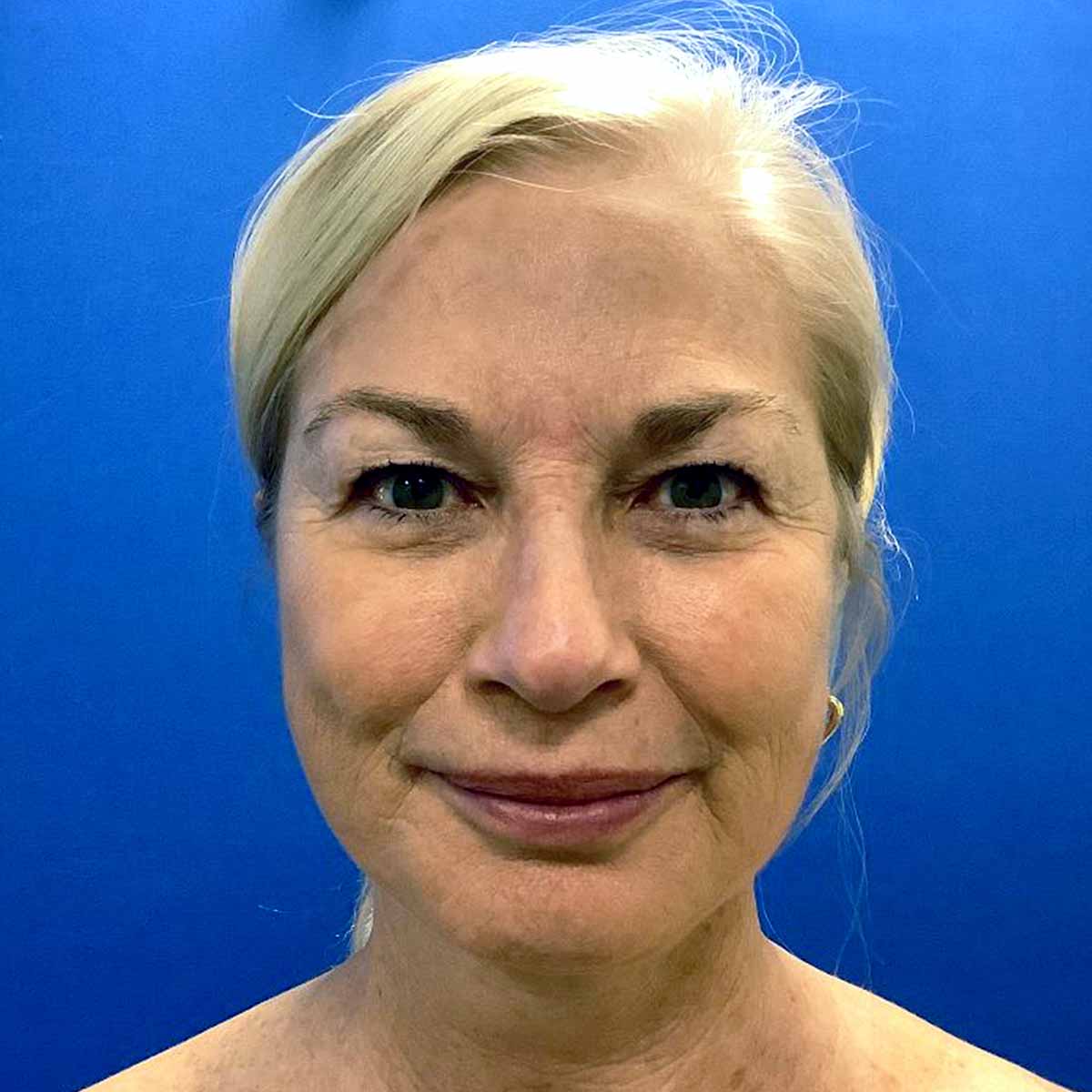 ZZZDJ - Hall & Wrye – Plastic Surgery and Medical Spa in Reno NV ...